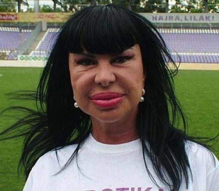 15 veces que las cirugías plásticas sobrepasaron las barreras del botox ...